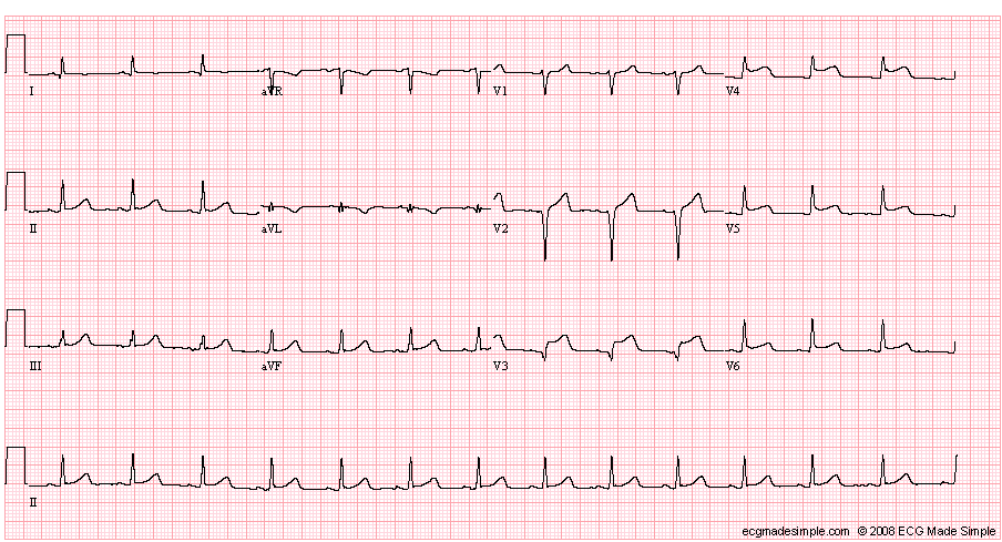 Case 1: A 47-Year-Old Man with Chest Pain - ECG Made Simple