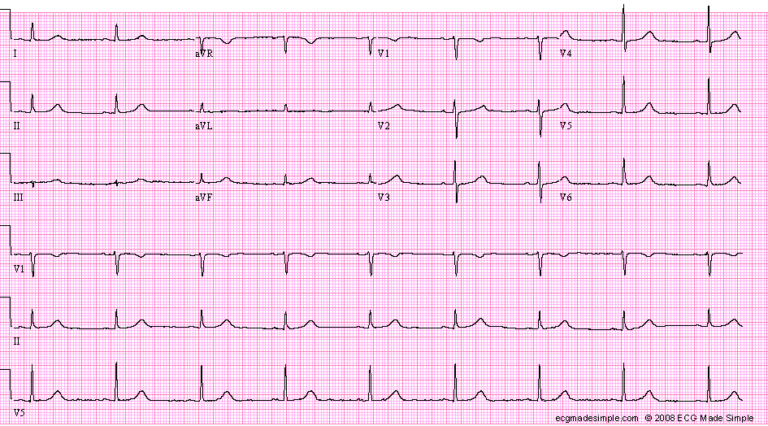 Level 1 - ECG Made Simple