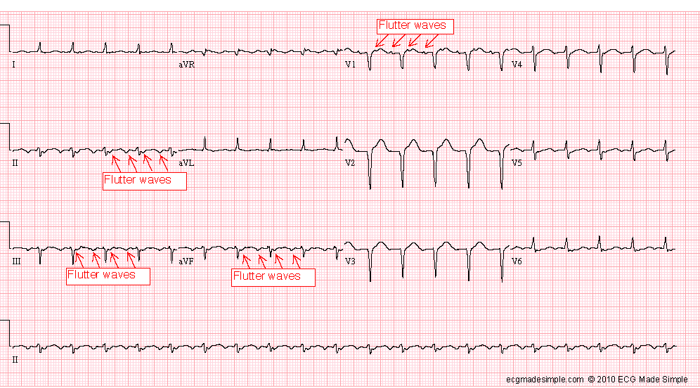 Case 99: A 77-Year-Old Man in the Emergency with Dyspnea - ECG Made Simple