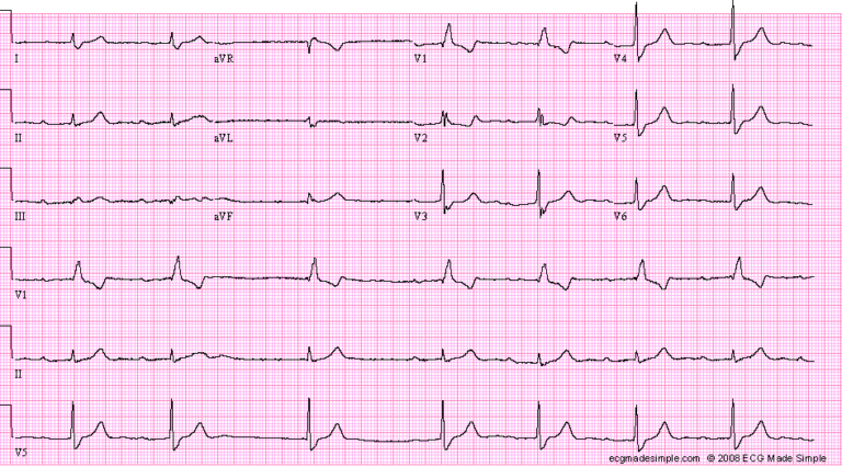Case 64: An 82-Year-Old Man with Abnormal ECG - ECG Made Simple