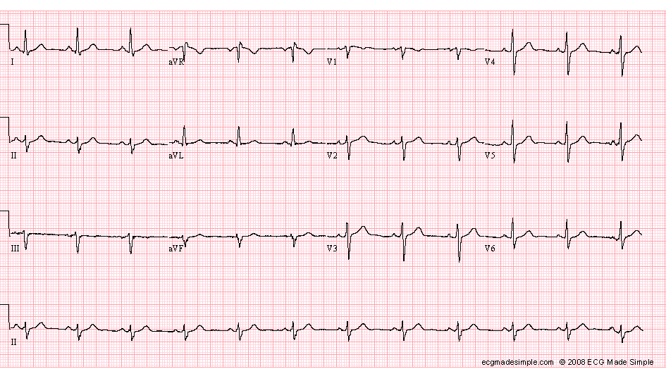 Case 62: A 53-Year-Old man with Palpitation and Faintness - ECG Made Simple