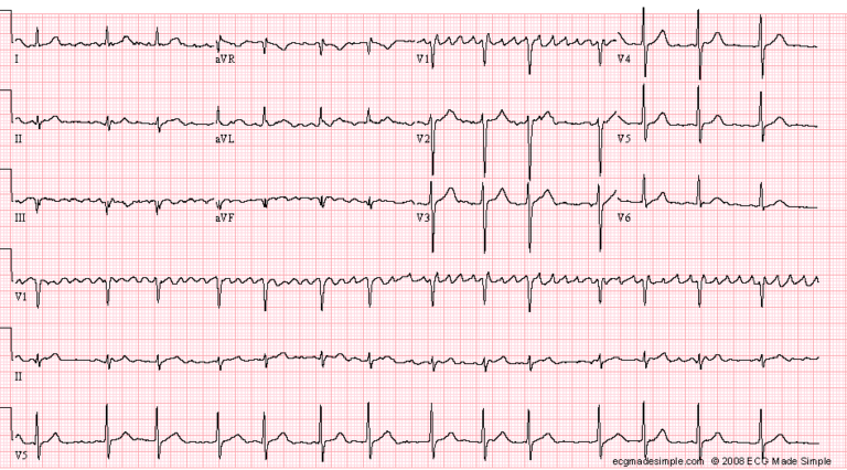 Case 61: A 46-Year-Old Man in the Cardiac Clinic - ECG Made Simple