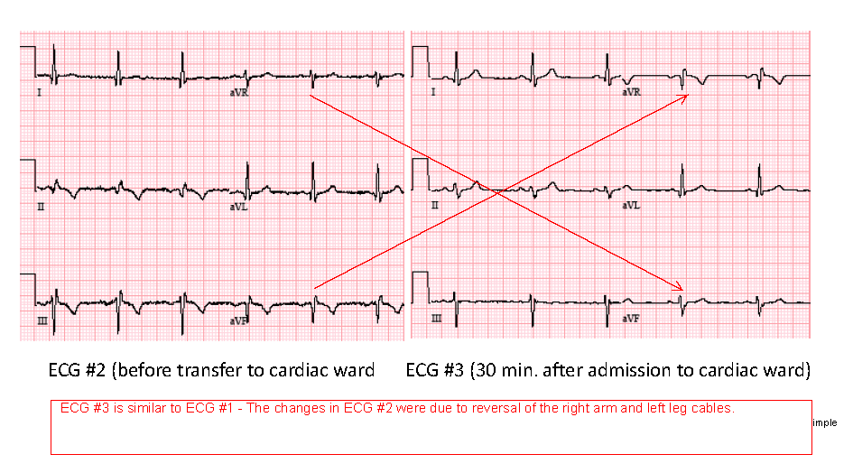 Case 55: A 45-Year-Old Man in the Emergency with Chest Pain - ECG Made ...