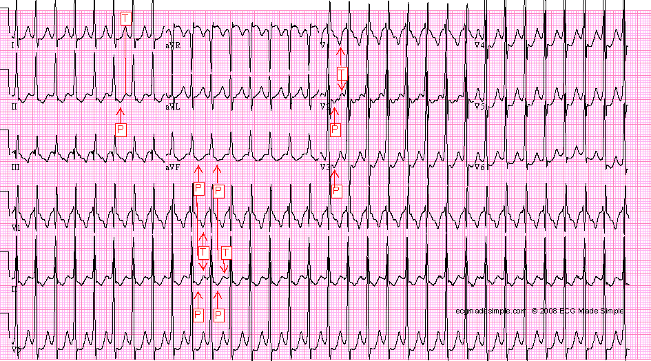 Case 93: A 45-Year-Old Man with Palpitations - ECG Made Simple