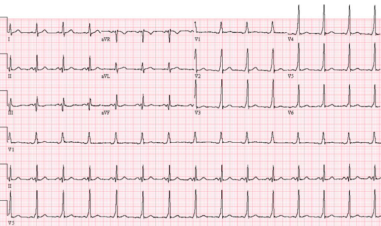 Case 47: A 51-Year-Old Man in the Cardiac Clinic - ECG Made Simple