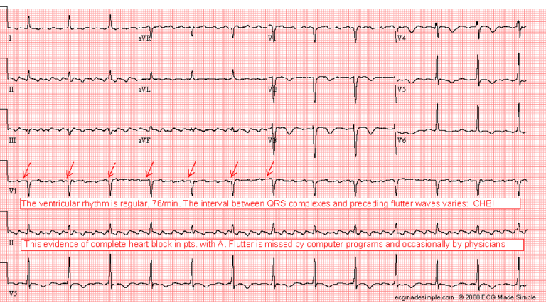 Case 36: A 79-Year-Old Man with Infective Endocarditis - ECG Made Simple