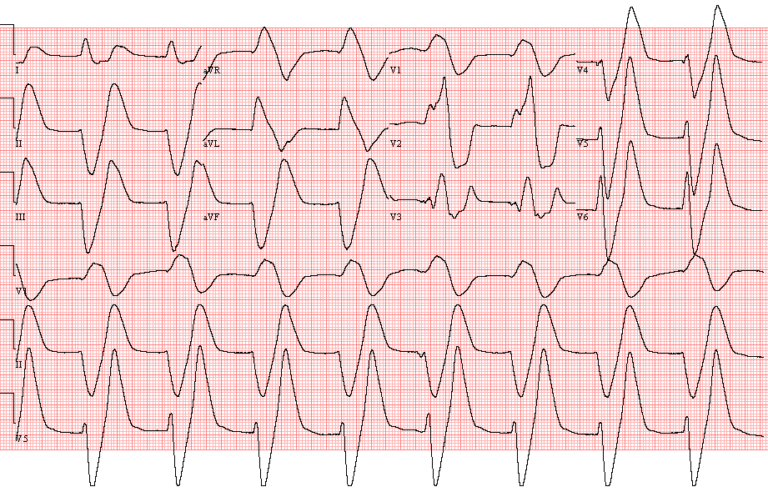 Case 26: A 55-Year-Old Man in the Emergency Department - ECG Made Simple