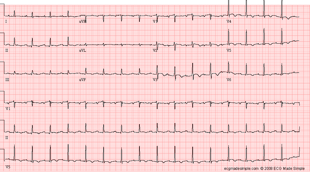 Case 53: An 81-Year-Old Man with Chest Pain - ECG Made Simple