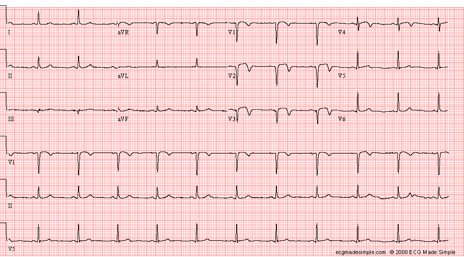 Case 11: A 49-Year-Old Man with Chest Pain - ECG Made Simple