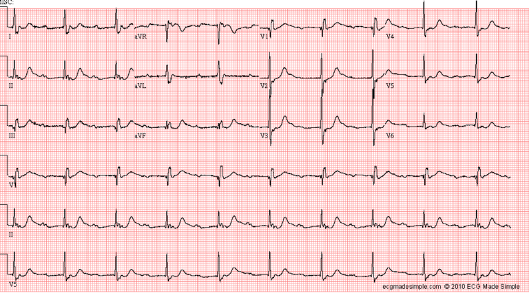 2:1 AV Block Archives - ECG Made Simple