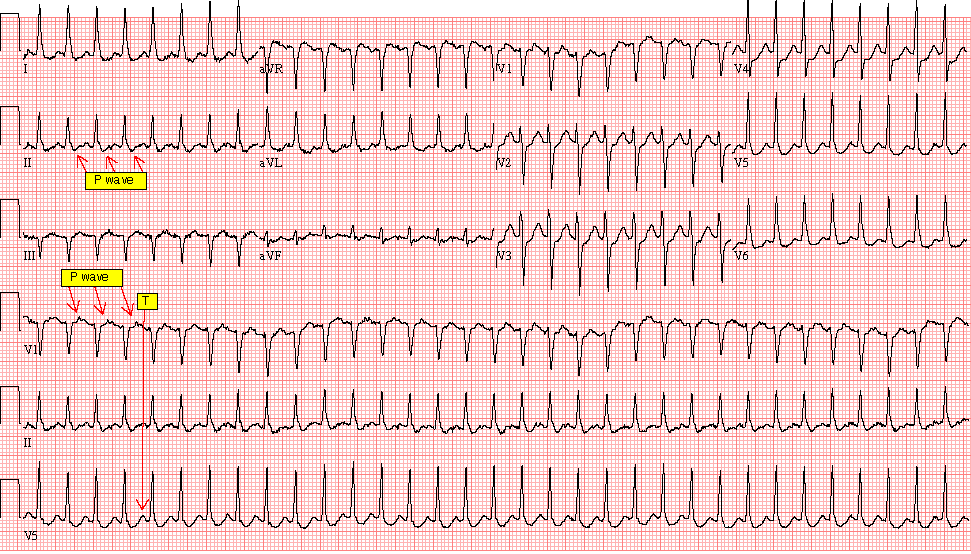 Case 95: A 76-Year-Old Woman with Episodes of Palpitation - ECG Made Simple