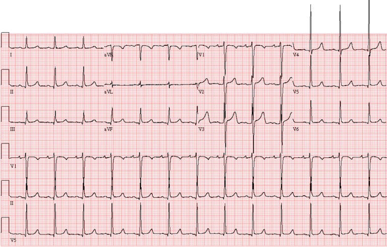 Case 15: A 32-Year-Old Man with Sickle Cell Disease - ECG Made Simple