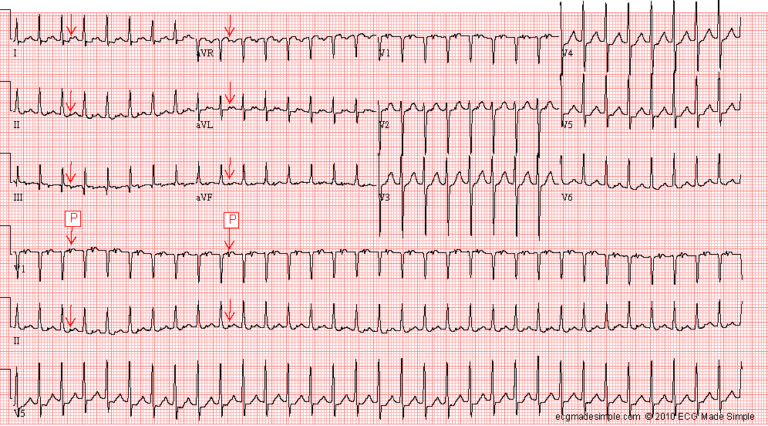 Case 14: A 43-Year-Old Man in the Emergency with Palpitations - ECG ...