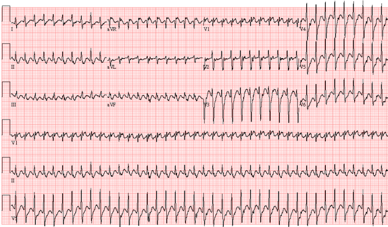 Case 94: A 73-Year-Old Man with Palpitations - ECG Made Simple