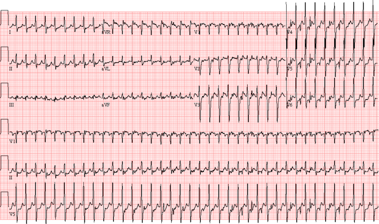 Case 13: A 62-Year-Old Man in the Emergency Department - ECG Made Simple
