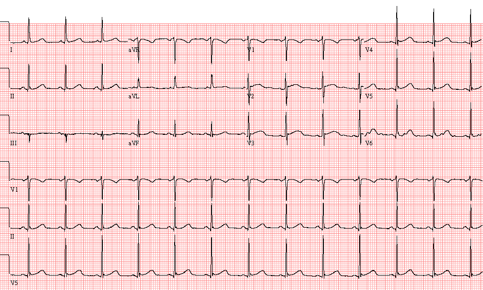 Case 17: A 66-Year-Old Woman Admitted with a Drug Overdose - ECG Made ...