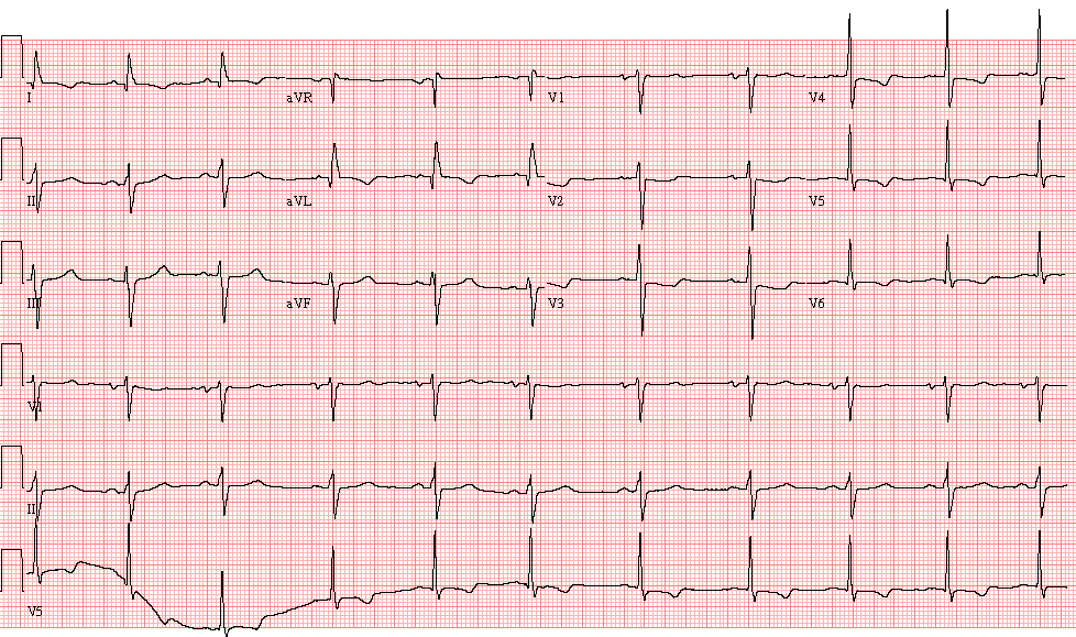 Case 15: A 63-Year-Old Woman in the Cardiac Clinic - ECG Made Simple