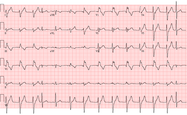 Accelerated Idioventricular Rhythm Archives - ECG Made Simple