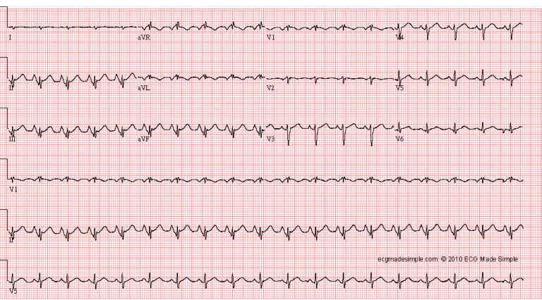 Level 3 - ECG Made Simple