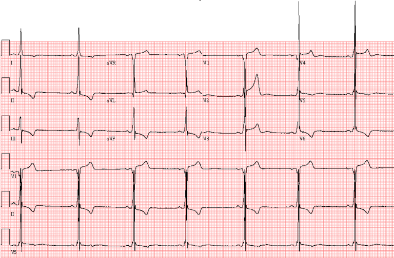 Case 4: A 44-Year-Old Man in the Cardiac Clinic - ECG Made Simple