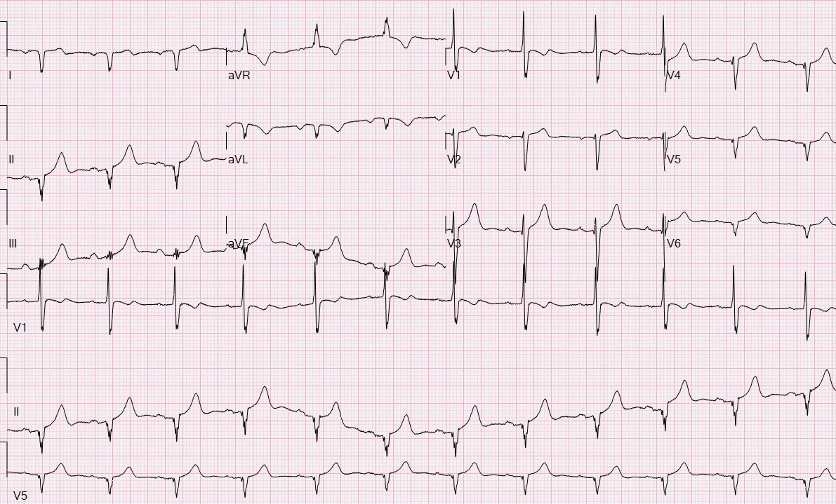 Case 3: A 42-Year-Old Man with Chest Pain - ECG Made Simple