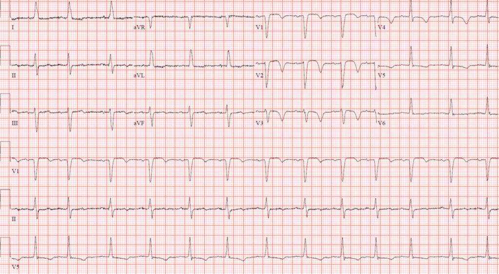 Case 1: An 82-Year-Old-Woman with Crescendo Angina - ECG Made Simple