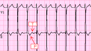 Atrioventricular Re-entrant Tachycardia - ECG Made Simple