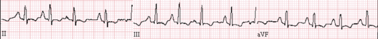 Right Atrial Enlargement - ECG Made Simple