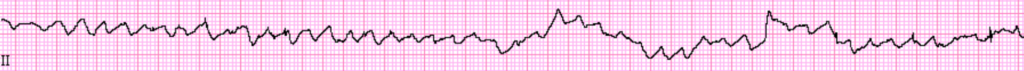 Ventricular Fibrillation - ECG Made Simple