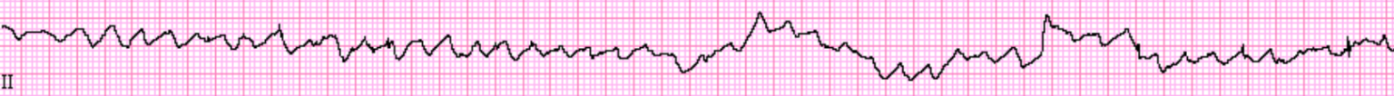 Ventricular Fibrillation - ECG Made Simple
