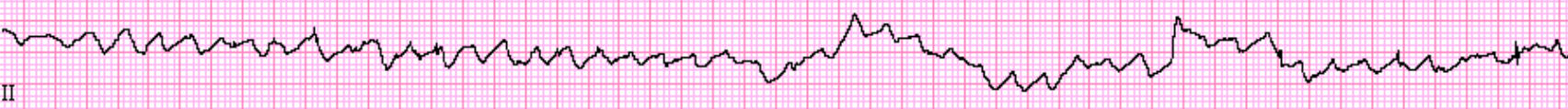 Ventricular Fibrillation - ECG Made Simple