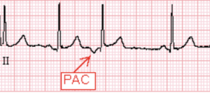 Premature Atrial Complex - ECG Made Simple