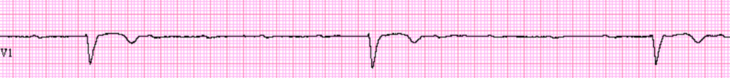 Ventricular Escape Rhythm - ECG Made Simple