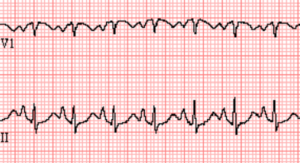 Biatrial Enlargement - ECG Made Simple