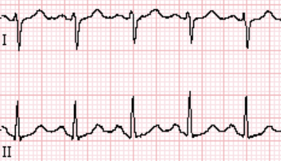 Left Posterior Fascicular Block - ECG Made Simple