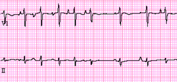 Multifocal Atrial Tachycardia - ECG Made Simple