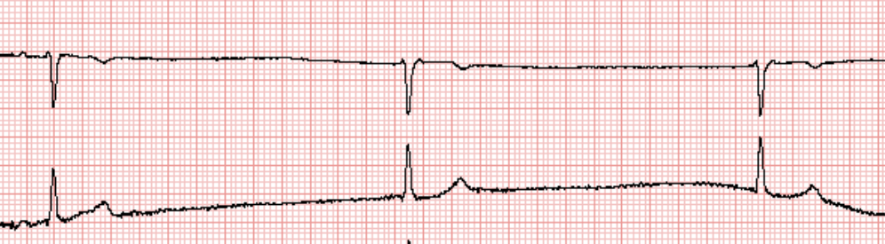 Sinus Pause - ECG Made Simple