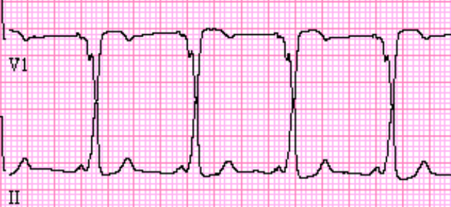 WPW - ECG Made Simple