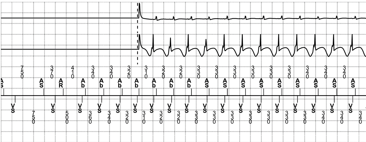 Case 4: An 87 Year-Old Man in Pacemaker Clinic for Routine Assessment ...